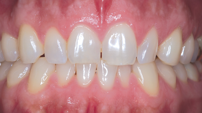 Obsidian All-Ceramic Crowns - Glidewell - Crown Lab