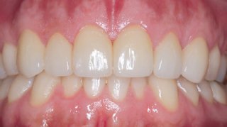 Obsidian All-Ceramic Crowns - Glidewell - Crown Lab