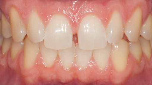 Obsidian All-Ceramic Crowns - Glidewell - Crown Lab