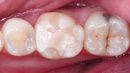 CAMouflage NOW for Inlays, Onlays, Veneers, Dental Crowns