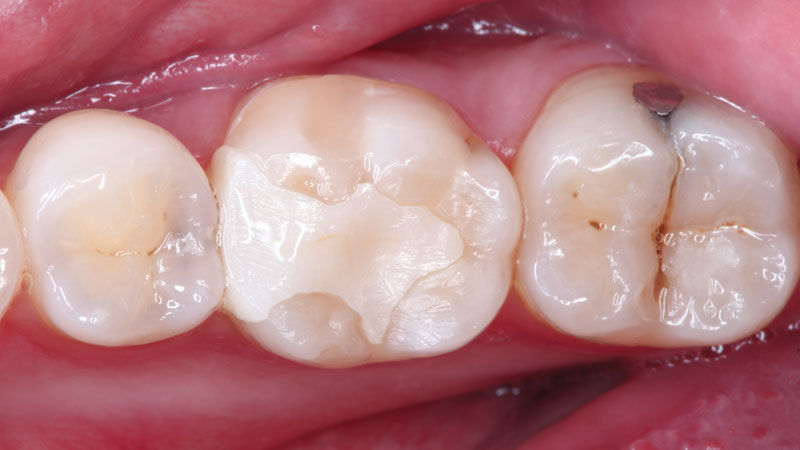 CAMouflage NOW for Inlays, Onlays, Veneers, Dental Crowns