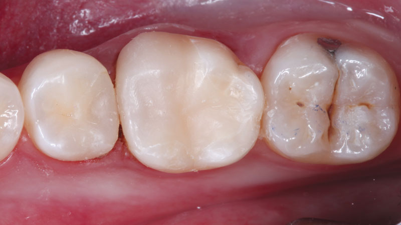 CAMouflage NOW for Inlays, Onlays, Veneers, Dental Crowns