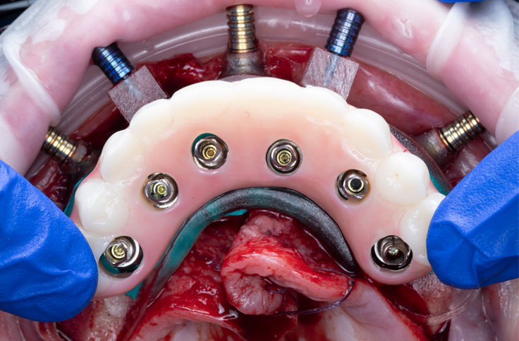 Stackable Surgical Guides - Glidewell Labs