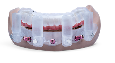 Surgical Guide for Dental Implant Placement - Glidewell Labs