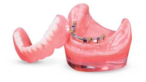 Locator® CAD/CAM-Milled Bar Overdenture | Glidewell