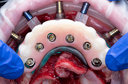 Glidewell HT Implant Guided Surgery System
