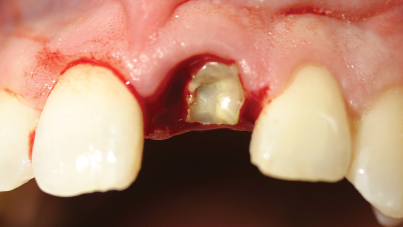 Glidewell HT Implant System. Place implants with confidence!