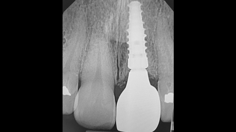 Glidewell HT Implant System. Place implants with confidence!