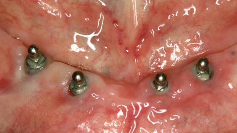 Inclusive Mini Implant System - Glidewell Dental Labs