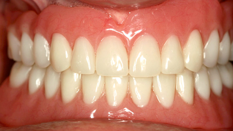 Inclusive Mini Implant System - Glidewell Dental Labs