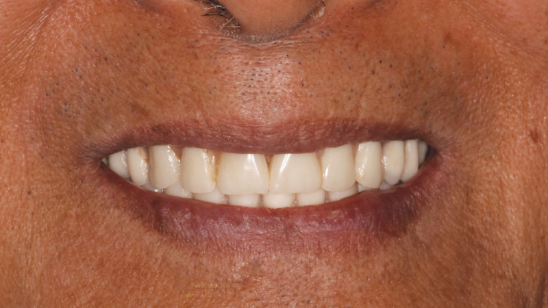 Inclusive Mini Implant System - Glidewell Dental Labs