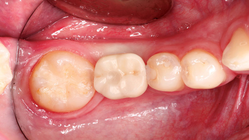 Inclusive Dental Prosthetics - Dental Implant Components