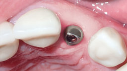 Glidewell Custom Abutment Implant Lab - Predictable Results
