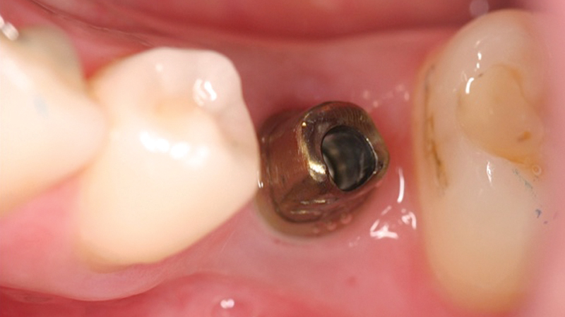 Glidewell Custom Abutment Implant Lab - Predictable Results