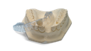 Essix Retainer - Glidewell