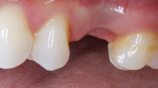Essix Retainer - Glidewell