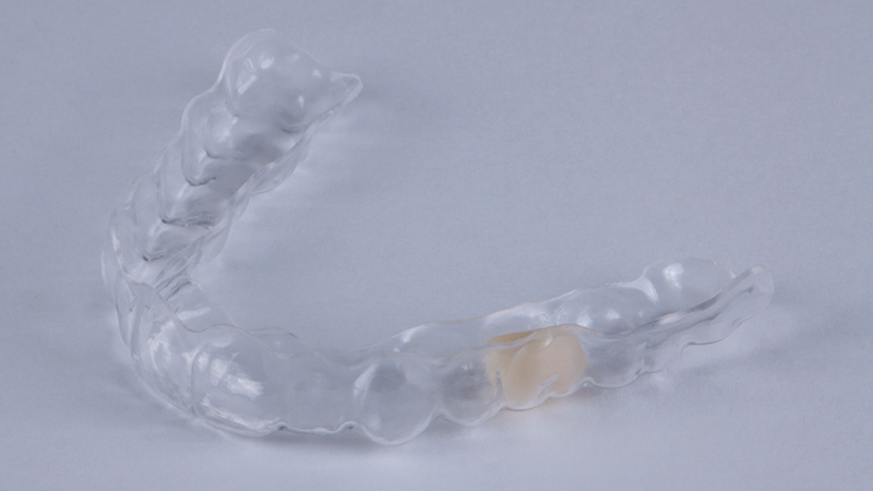 Essix Retainer - Glidewell