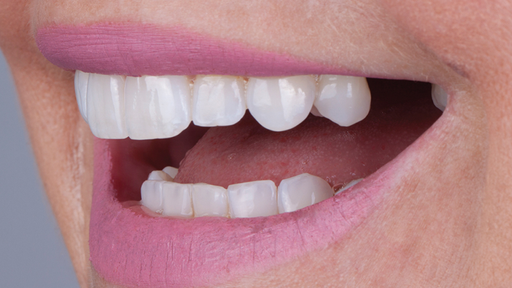 Essix Retainer - Glidewell
