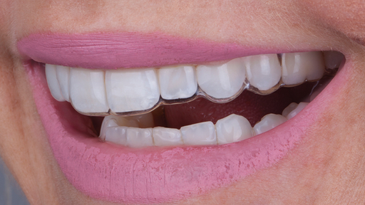 Essix Retainer - Glidewell