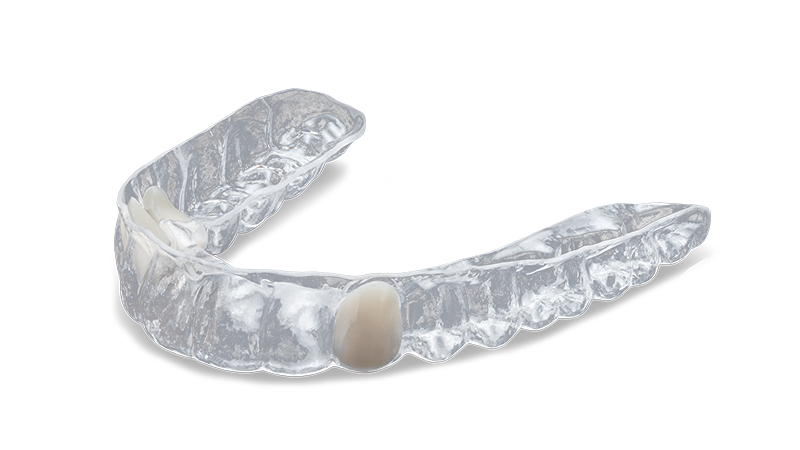 Essix Retainer - Glidewell