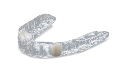 Essix® Retainer - Glidewell