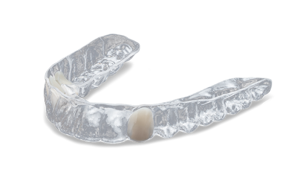 Essix Retainer - Glidewell