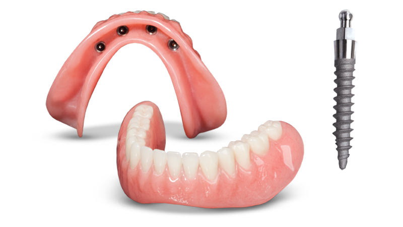 Mini Implant Overdenture Glidewell