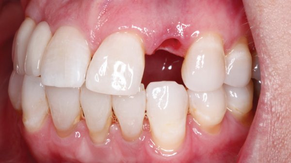 Screw-Retained Implant Crown - Glidewell Dental Lab