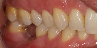 CLEARsplint - Bite Splint - Mouth Guard for Bruxing