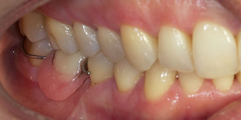 CLEARsplint - Bite Splint - Mouth Guard for Bruxing