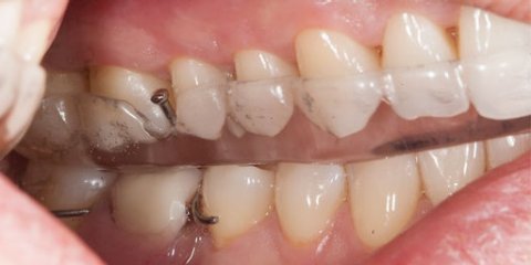 CLEARsplint - Bite Splint - Mouth Guard for Bruxing