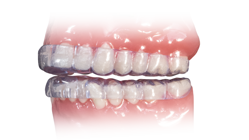 NTI OmniSplint from Glidewell