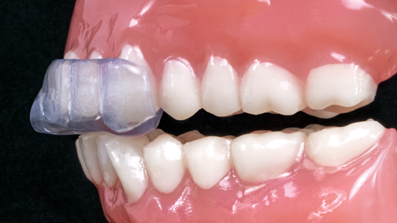 NTI-tss Plus from Glidewell