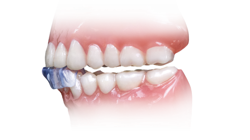 NTI-tss Plus from Glidewell