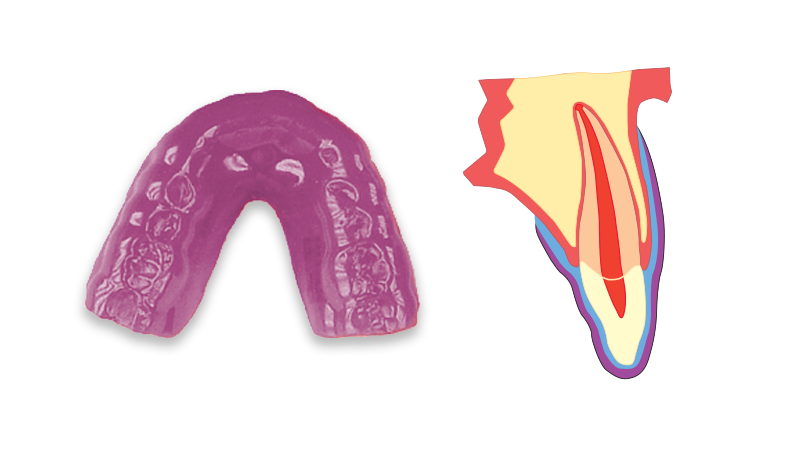 Custom Mouthguard - PlaySafe Sports Mouthguard - Glidewell