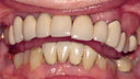 BioTemps® Provisionals - Glidewell Dental Lab