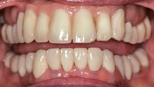 BioTemps® Provisionals - Glidewell Dental Lab