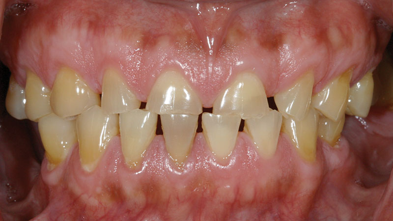 BioTemps® Provisionals - Glidewell Dental Lab