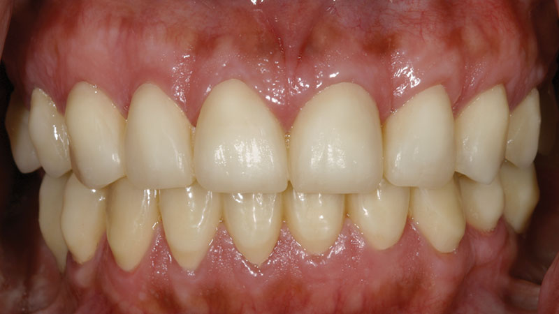 BioTemps® Provisionals - Glidewell Dental Lab