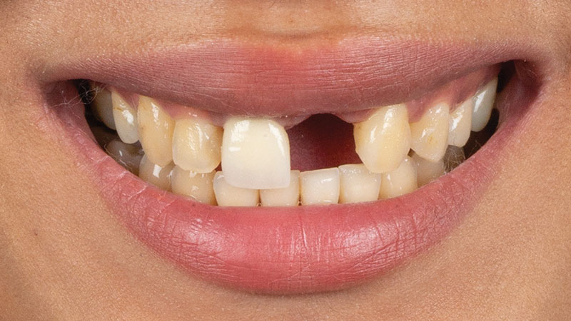 Temporary Crowns - Smile Transitions™ - Provisionals Dental