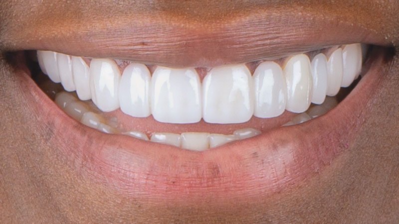 Temporary Crowns - Smile Transitions™ - Provisionals Dental
