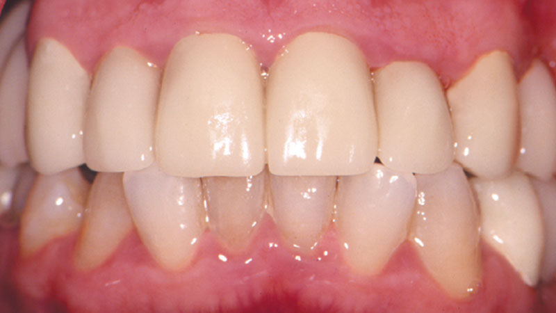 Looking for a long-term provisional crown or bridge?