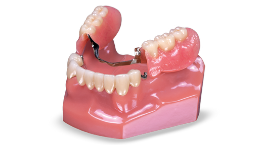 Glidewell Labs - Exceptional Combination Crowns and Partials