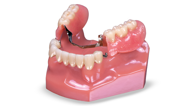 Glidewell Labs - Exceptional Combination Crowns and Partials