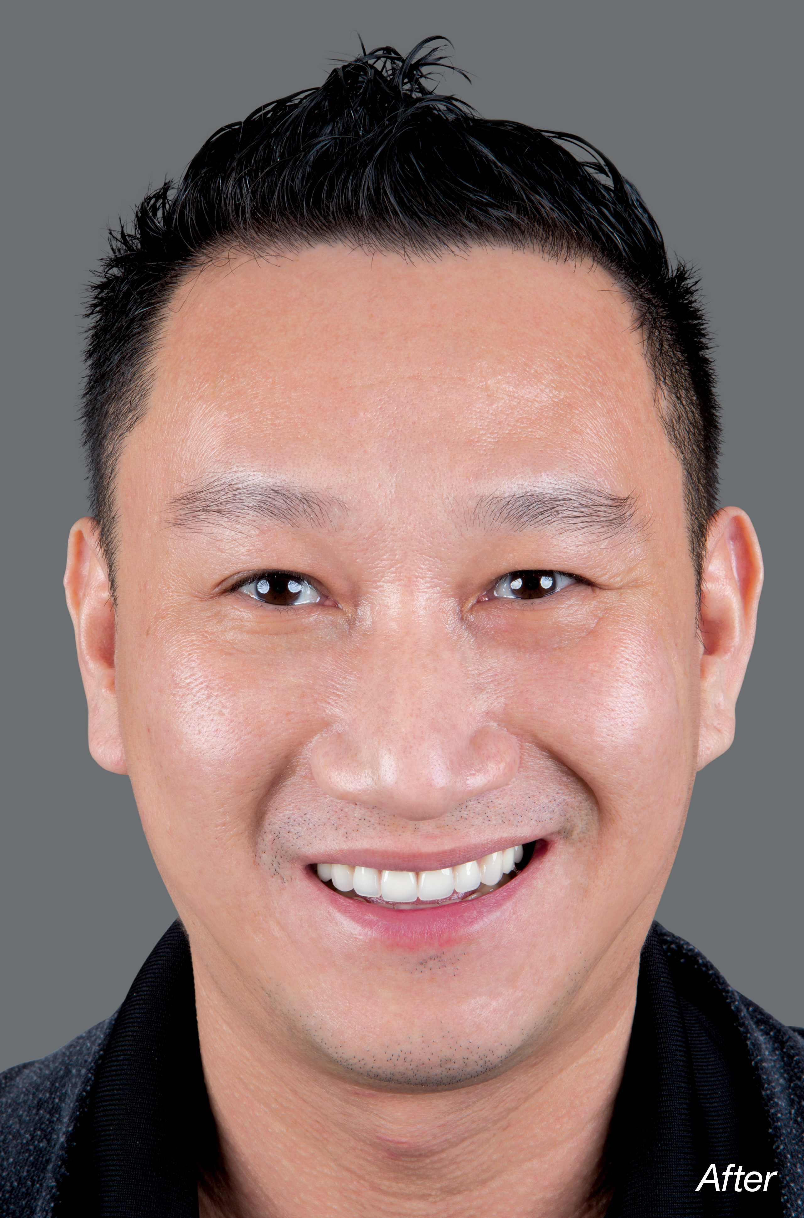 Dentures - Simply Natural™ Dentures - Dentures Dental Lab