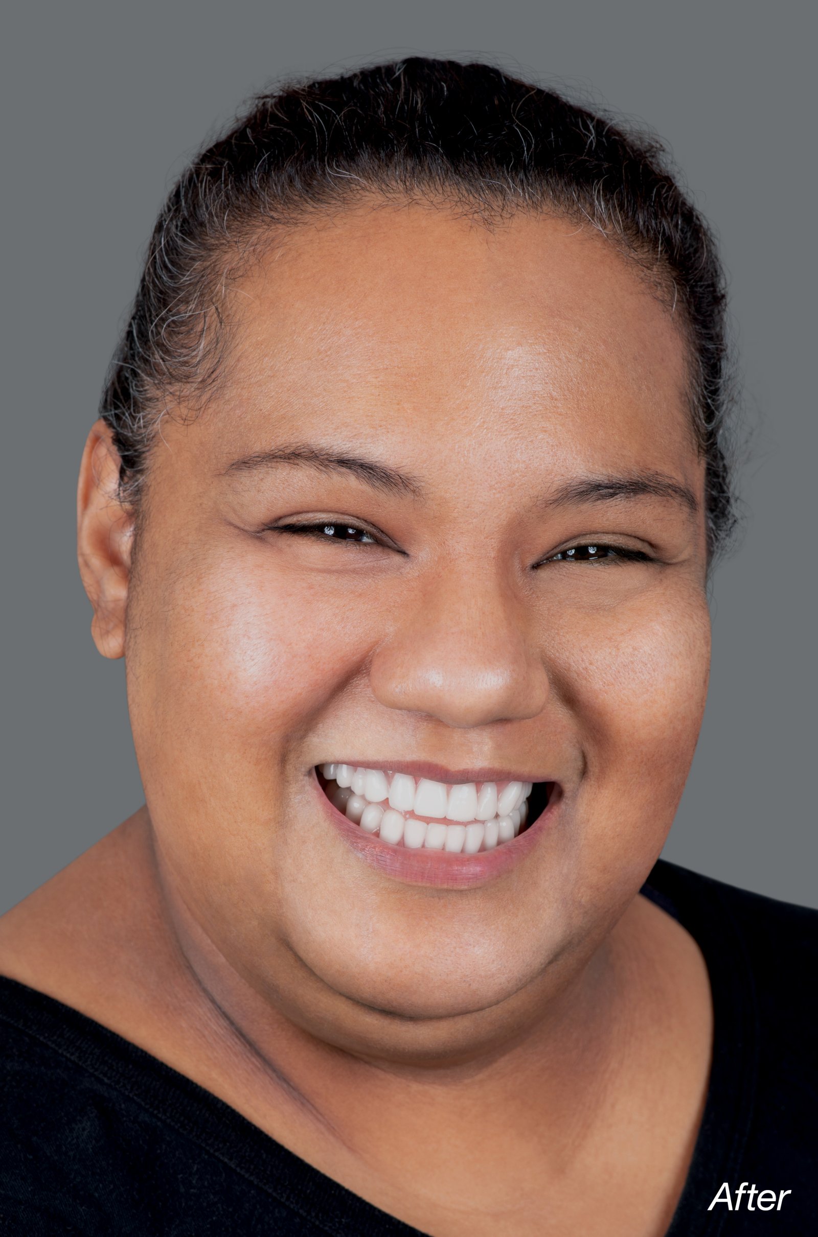 Dentures - Simply Natural™ Digital Dentures - Dentures Dental Lab