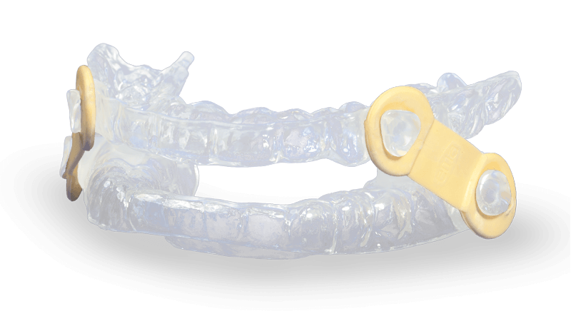 Mandibular Advancement Device - EMA® Oral Appliance
