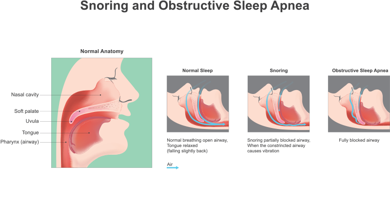 Snoring & Sleep Apnea - Oasys Hinge- Herbst Dental Appliance
