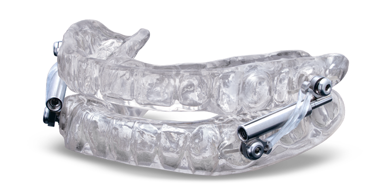 Silent Nite With Glidewell Hinge — Oral Appliance For Sleep Apnea