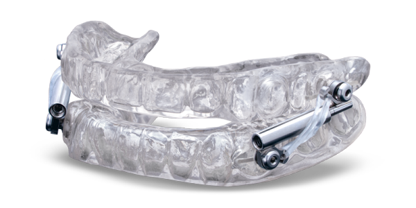 Silent Nite with Glidewell Hinge — Oral Appliance for Sleep Apnea